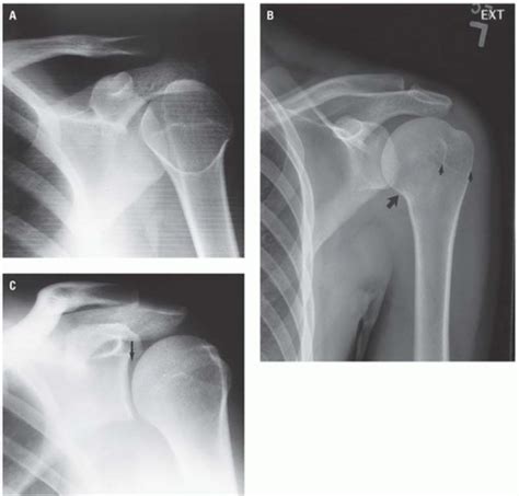 Shoulder Including Clavicle And Scapula Radiology Key