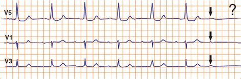 Second Degree Av Block Mobitz I Wenckebach Ecg Book