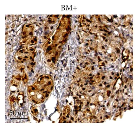 expression of bone markers in prostate cells a graph shows the