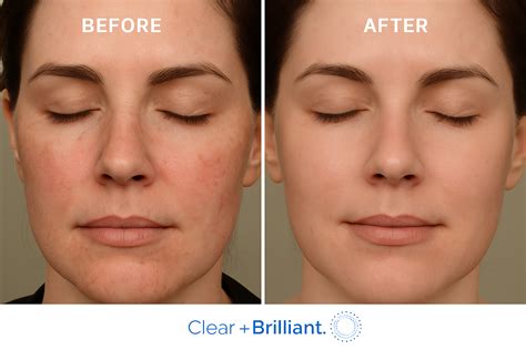Is Clear Brilliant Laser Treatment Worth It Real Results