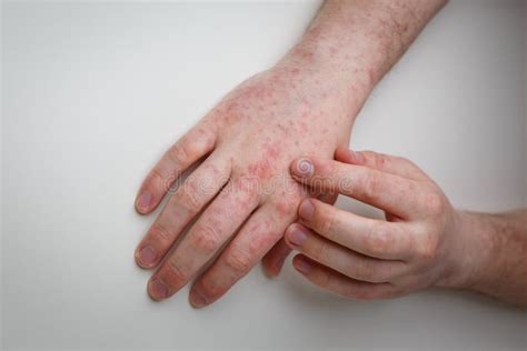 Allergy Red Itchy Rash On Male Hands On White Table Dermatological