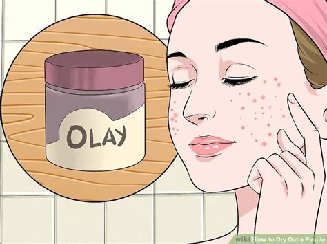 Ways To Dry Out A Pimple WikiHow