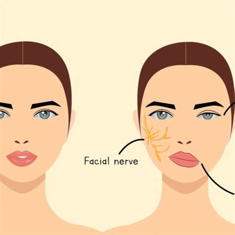 የህጻናት አንድ እጅ መስነፍ Brachial Plexus Palsy Erbes Palsy Shegerphysio