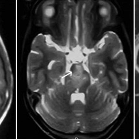 Mri T1 Weighted Image A Showing The Hypointense Well Defined Lesion