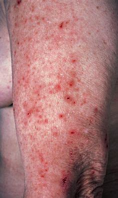 Photosensitivity Lupus Rash From Sun Exposure Rash From Sun Psoriatic