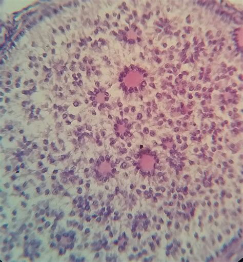 Pathology Outlines Sex Cord Tumor With Annular Tubules