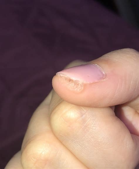 Wrat Eelt Aan Vinger Medische Forum Dokter Nl