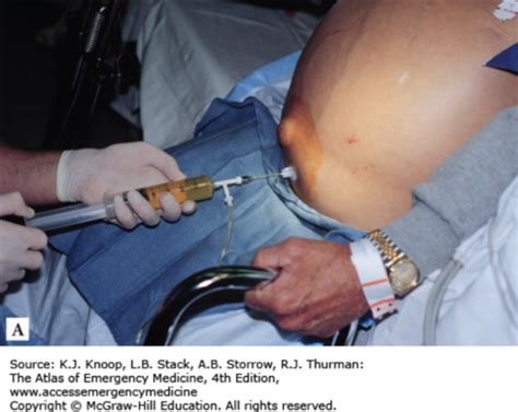 Peritoneal Disorders Flashcards Quizlet