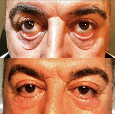 Ectropion Correction Gallery Soroudi Advanced Lasik And Eye Centers