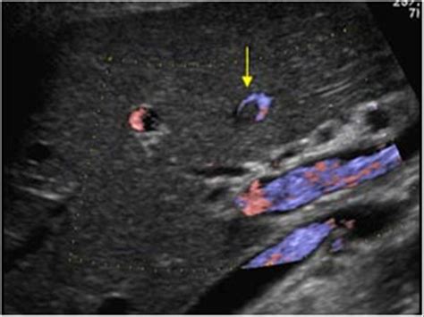 Abdomen And Retroperitoneum 11 Liver Case 1113 Hepatic And