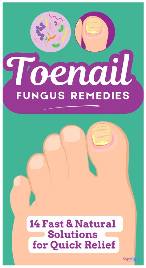 Nail Fungus Remedy Toenails Artofit