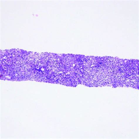 Histology Of Liver Biopsy Macrovesicular Steatosis Occupying About 65