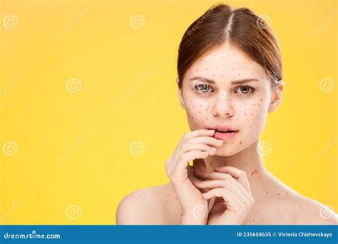 Frau Mit Nackten Schultern Rote Punkte Auf Ihrem Gesicht Gesundheitsprobleme Dermatologie