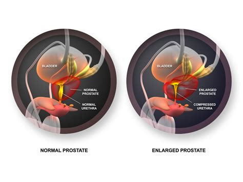 Prostate Gland