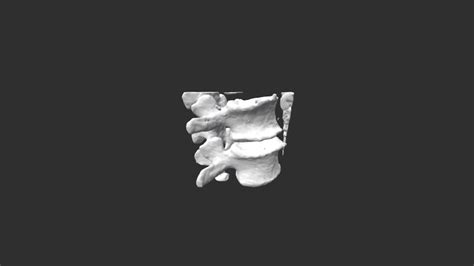 Converting Dicom Into Stl 3d Model By Gonzalo Espino Gómez
