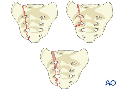 Aospine Classification Aospine Classification