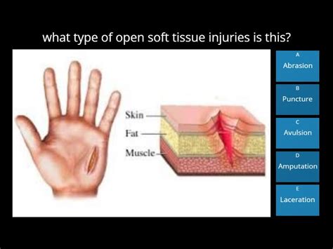 Soft Tissue Injuries Cuestionario