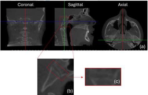 논문 리뷰 Knowledge Distillation Approach For Sos Fusion Staging Towards Fully Automated Skeletal