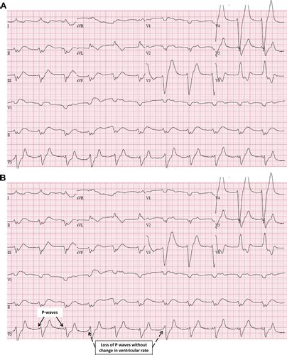 Sinoventricular Conduction In The Setting Of Severe Hyperkalemia Jacc