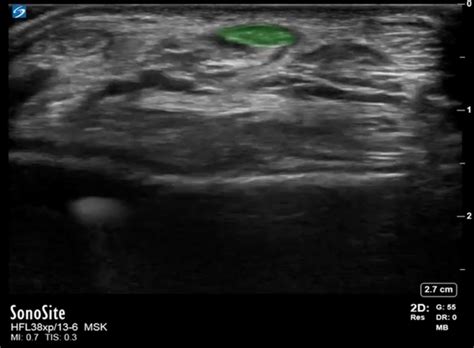 Foot And Ankle Anterior Recess Extensor Hallucis Longus Image Sonosite