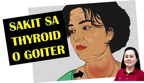 Doc Willie Ong Sakit Sa Thyroid O Goiter Payo Ni Doc
