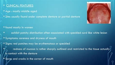 1 Denture Stomatitispptxftyftyytfytftfty Ppt