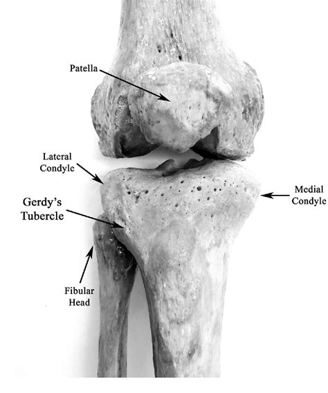 Figure 1 From Mandibular Reconstruction With Lateral Tibial Bone Graft