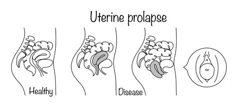 Abnormal Uterine Bleeding Royalty Free Vector Image