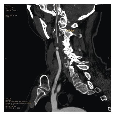 Mdct Angiography Of Type Ii Segmental Ica Occlusion Multiplanar
