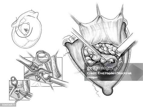 Craniotomy Photos And Premium High Res Pictures Getty Images
