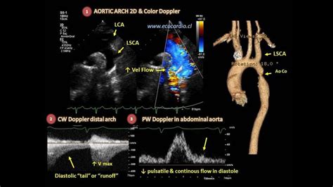 23 Best Pediatric Echocardiography Images On Pinterest Cardiac