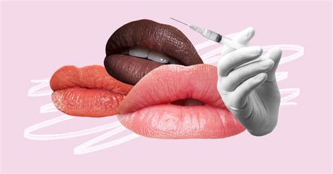 Lip Flip And Lip Filler Injections Everything To Know