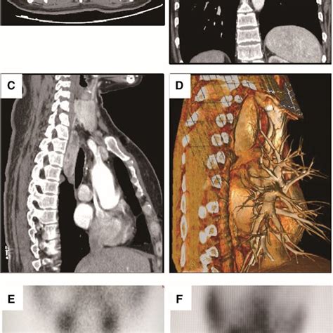 Computed Tomography Ct Scan And 99m Technetium Sestamibi Scanning Of Download Scientific