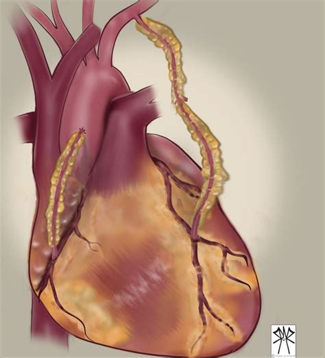 Serdar ÇelİktaŞ On Linkedin Coronary Artery Bypass Surgery Lita Lima Radialartery Serdar ÇelİktaŞ On Linkedin Coronary Artery Bypass Surgery Lita Lima Radialartery