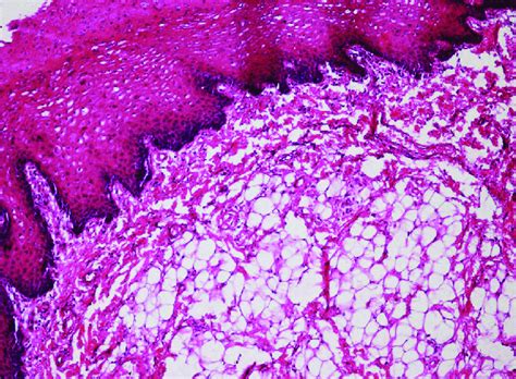 Photomicrograph Showing Fibrocellular Connective Tissue Stroma With