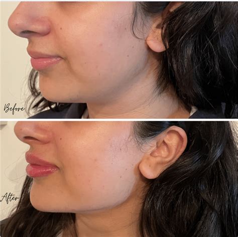 Before And After Of Jawline Filler Persona Medical Aetshetics — Persona