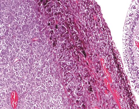 Epithelioid Cells With Marked Nuclear Hyperchromatism In Ocular