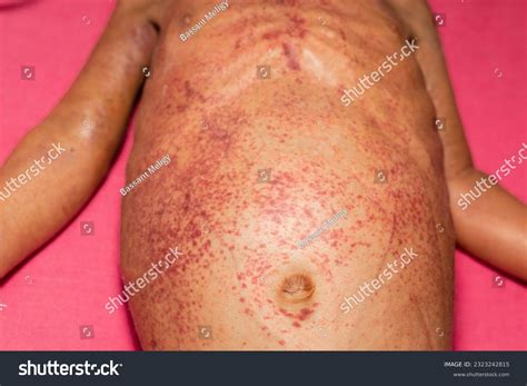 Petechial Hemorrhage In The Chest