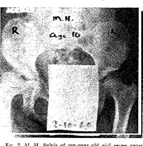 Figure 1 From Congenital Hip Dysplasia Semantic Scholar