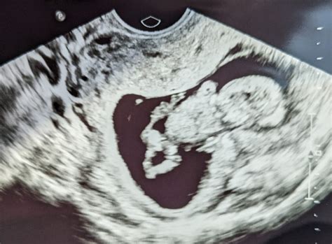 To The Mama Going Through Pregnancy After Recurrent Miscarriage • Mama