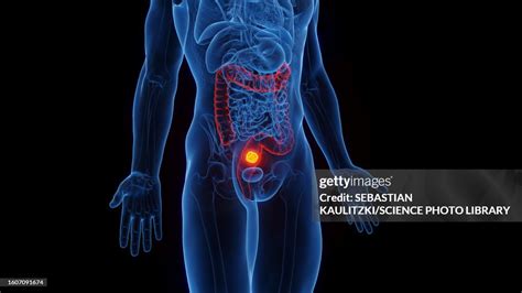Rectal Cancer Illustration High Res Vector Graphic Getty Images