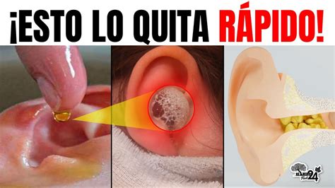 DILE ADIOS A LA PICAZON EN LOS OIDOS Y OIDOS TAPADOS Con Estos