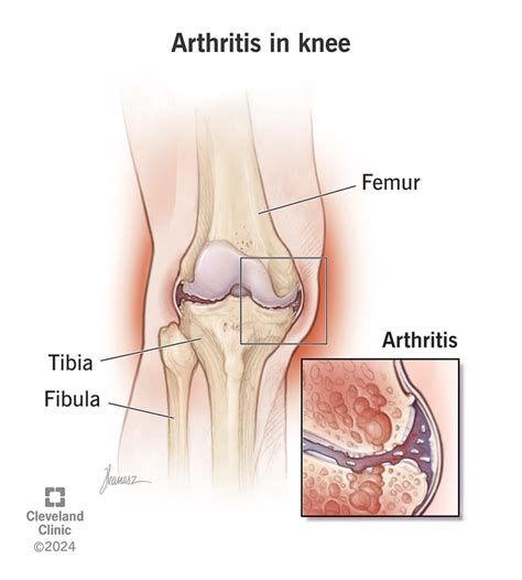 Osteoarthritis Of The Knee Symptoms Causes Treatments