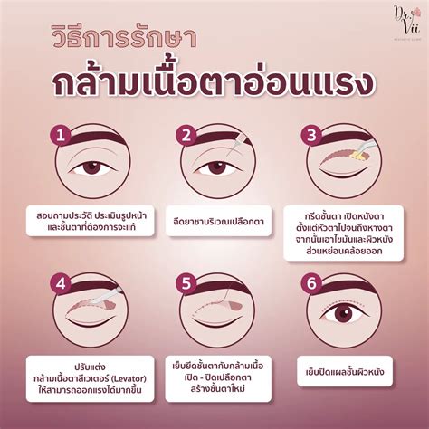 เช็คด่วน กำลังมีอาการ “ตาปรือ” อยู่หรือเปล่า แกลเลอรีที่โพสต์โดย Dr