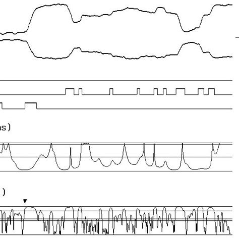 b examples of automatic detection of eye movement signals during rem