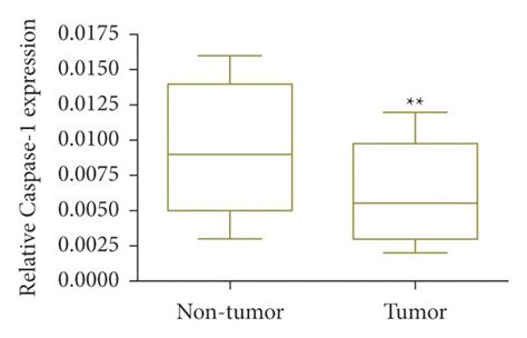 The Clinical Association Of Hdac1 Caspase 1 And Gsdmd In Nsclc
