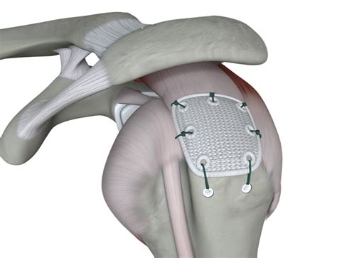 Pitch Patch Open Technique In SItu Xiros