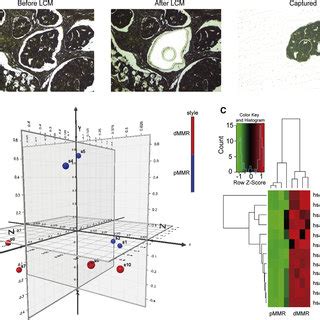 Microdissection And MiRNA Microarray Analysis Of DMMR And PMMR Colon