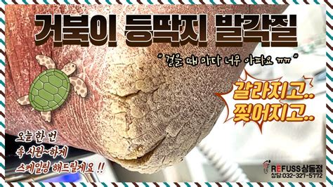 🐢거북이 등딱지처럼 딱딱한‼️ 과각화 무좀발각질 관리 Hyperkeratosis Athletes Foot Keratin