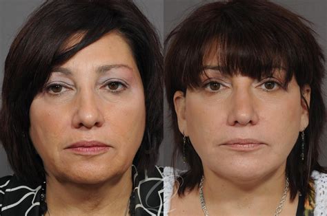 Chin Augmentation Before And After Photos Patient 55 Serving Rochester